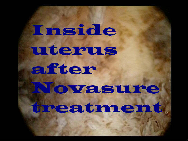 Novasure Dr Serag Youssif